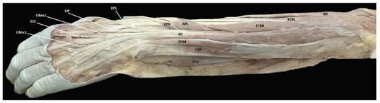 Presumed Presence of Extensor Indicis et Digiti Medii Communis Muscle ...