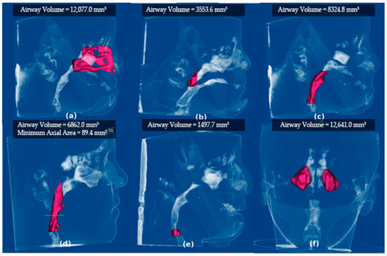 Anatomia | Free Full-Text | Three-Dimensional Assessment of the Pharyngeal Airway in Growing ...