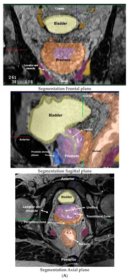 Geometric Anatomy Basis For Safe And Effective Focal Ablation Of