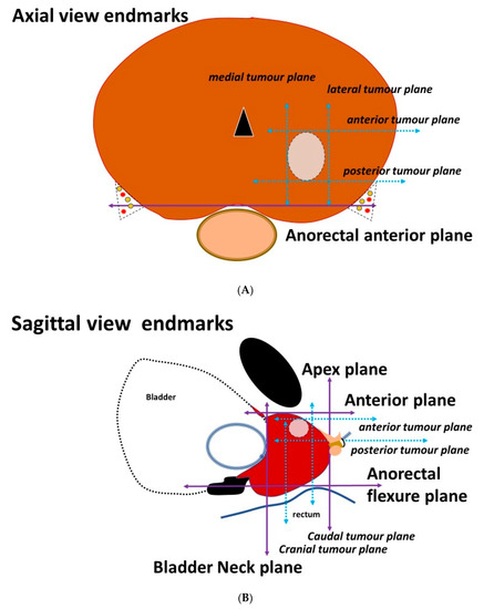 Geometric Anatomy Basis for Safe and Effective Focal Ablation of ...