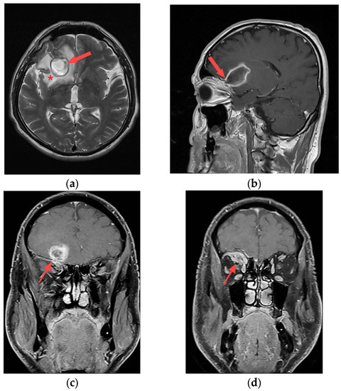 Brain Abscess Secondary to an Apparently Benign Transorbital Injury: An ...