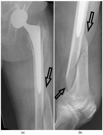 Femur Anatomia Femur Anatomia