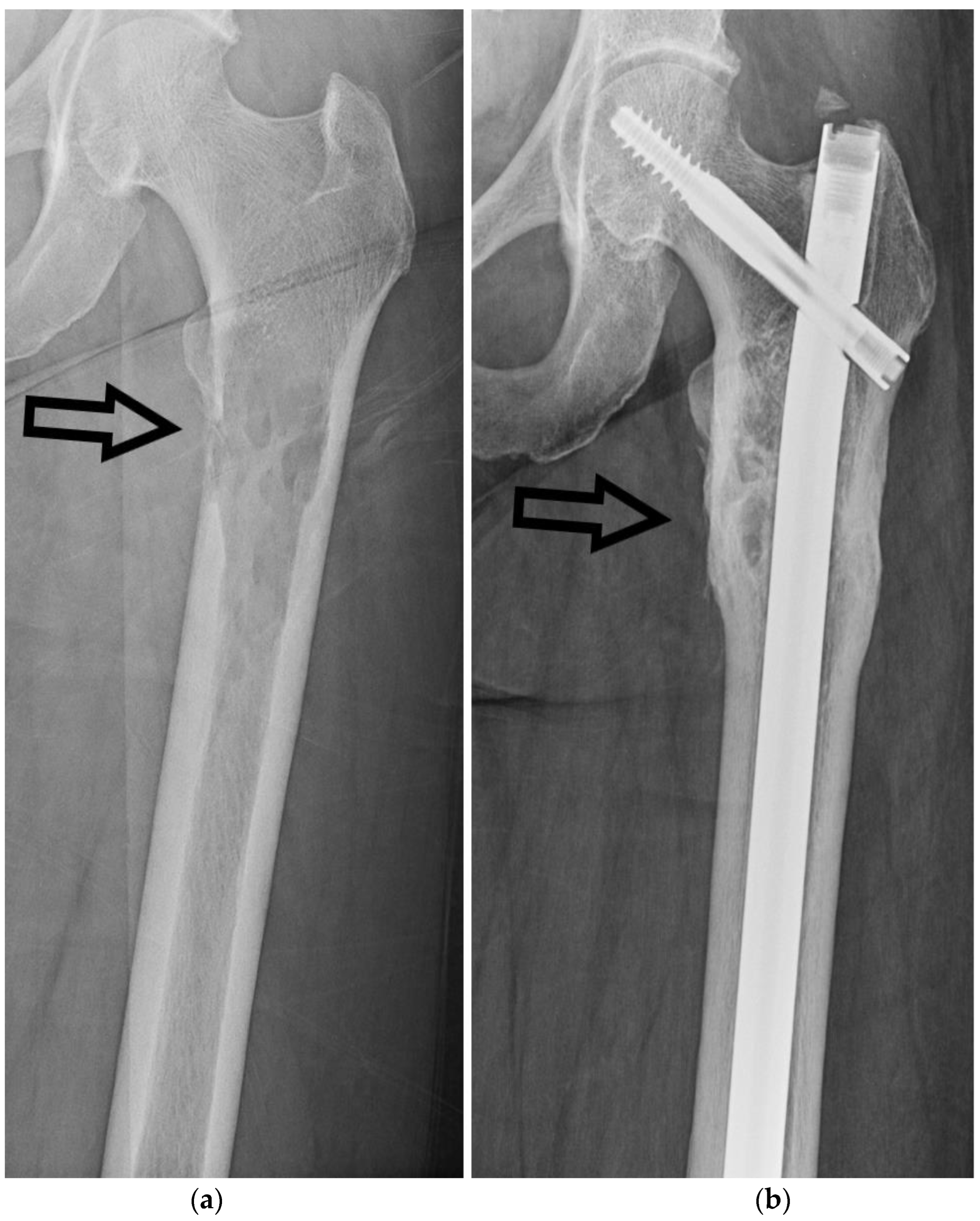 Radiological Diagnosis and Imaging of Femoral Shaft Fractures