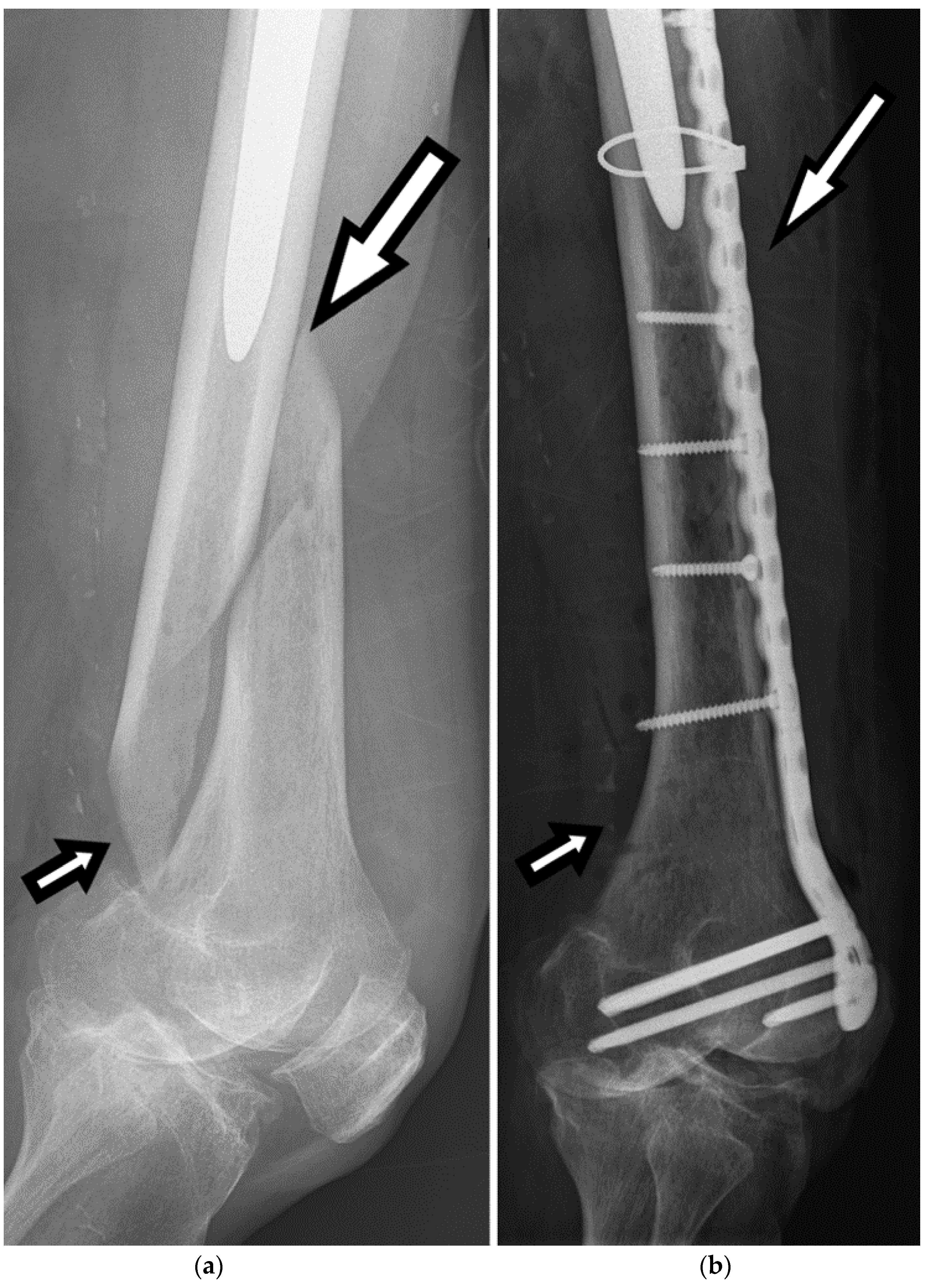 Radiological Diagnosis and Imaging of Femoral Shaft Fractures