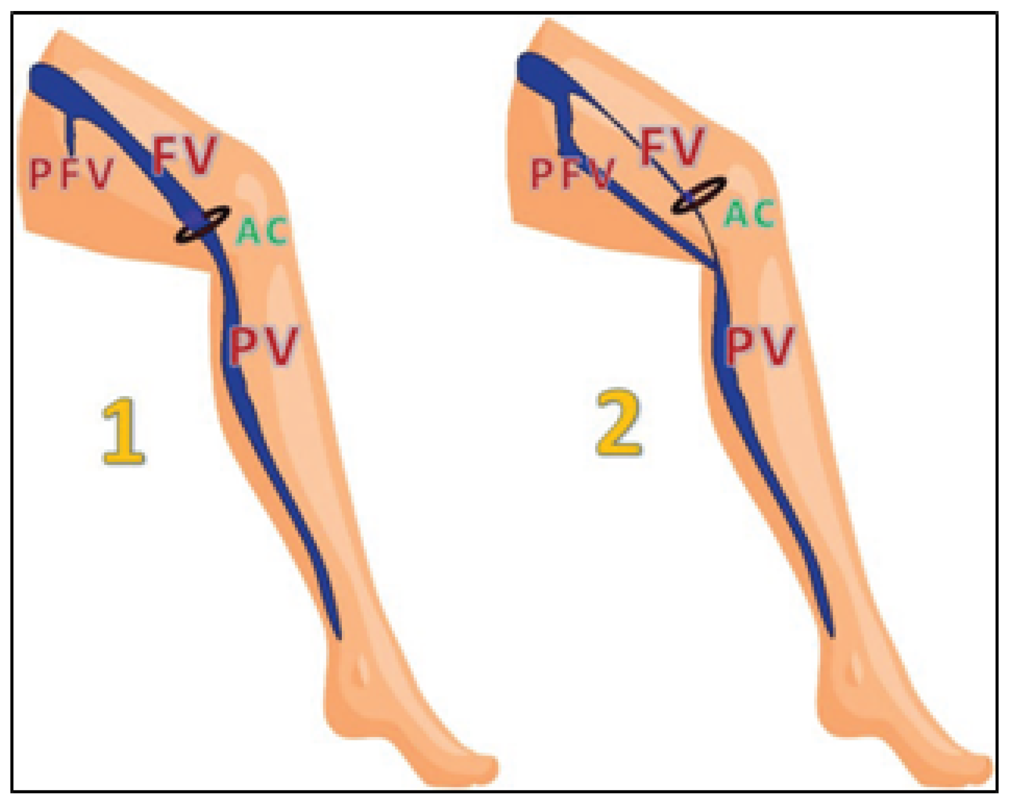 Clinical Anatomy of the Lower Extremity Veins—Topography, Embryology ...