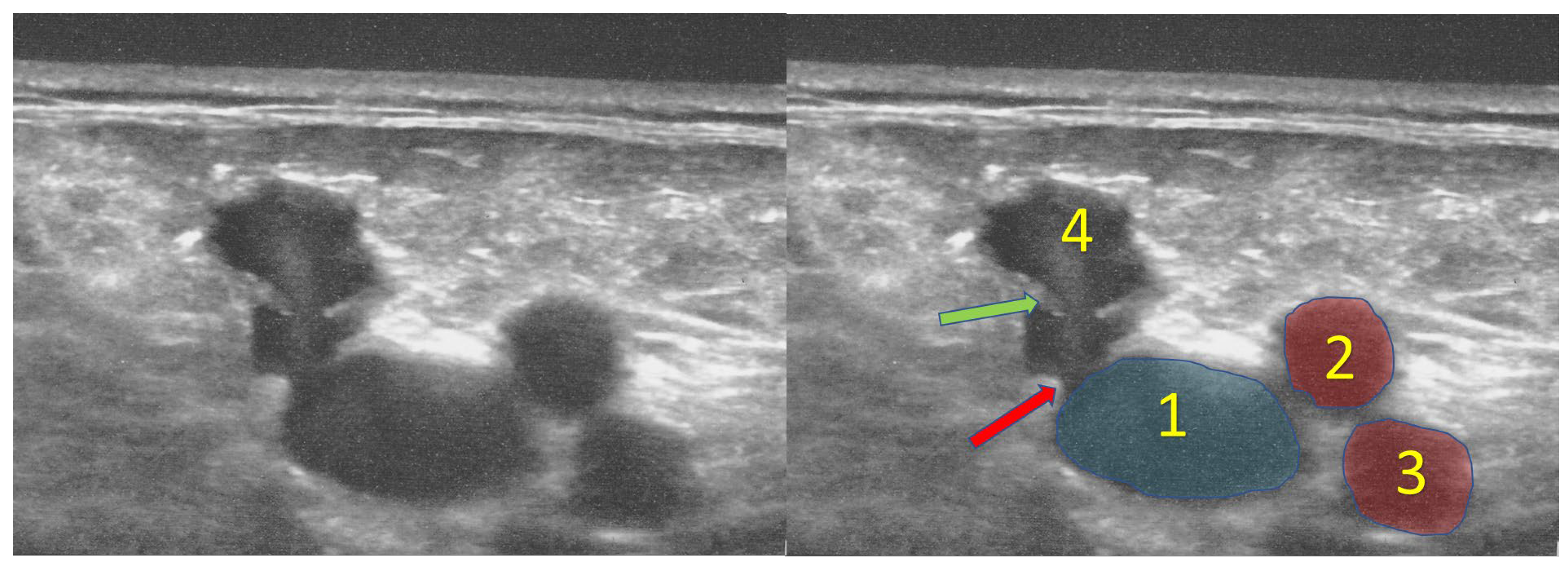 Clinical Anatomy of the Lower Extremity Veins—Topography, Embryology ...