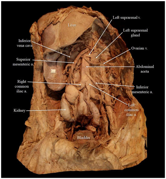 Anatomical and Histological Analyses of Rare Pancake Kidney