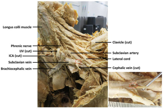 Sympathetic Chain Cadaver