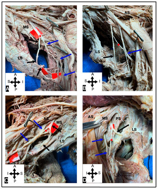 Interconnected Anatomy and Clinical Relevance of the Dorsal Scapular ...