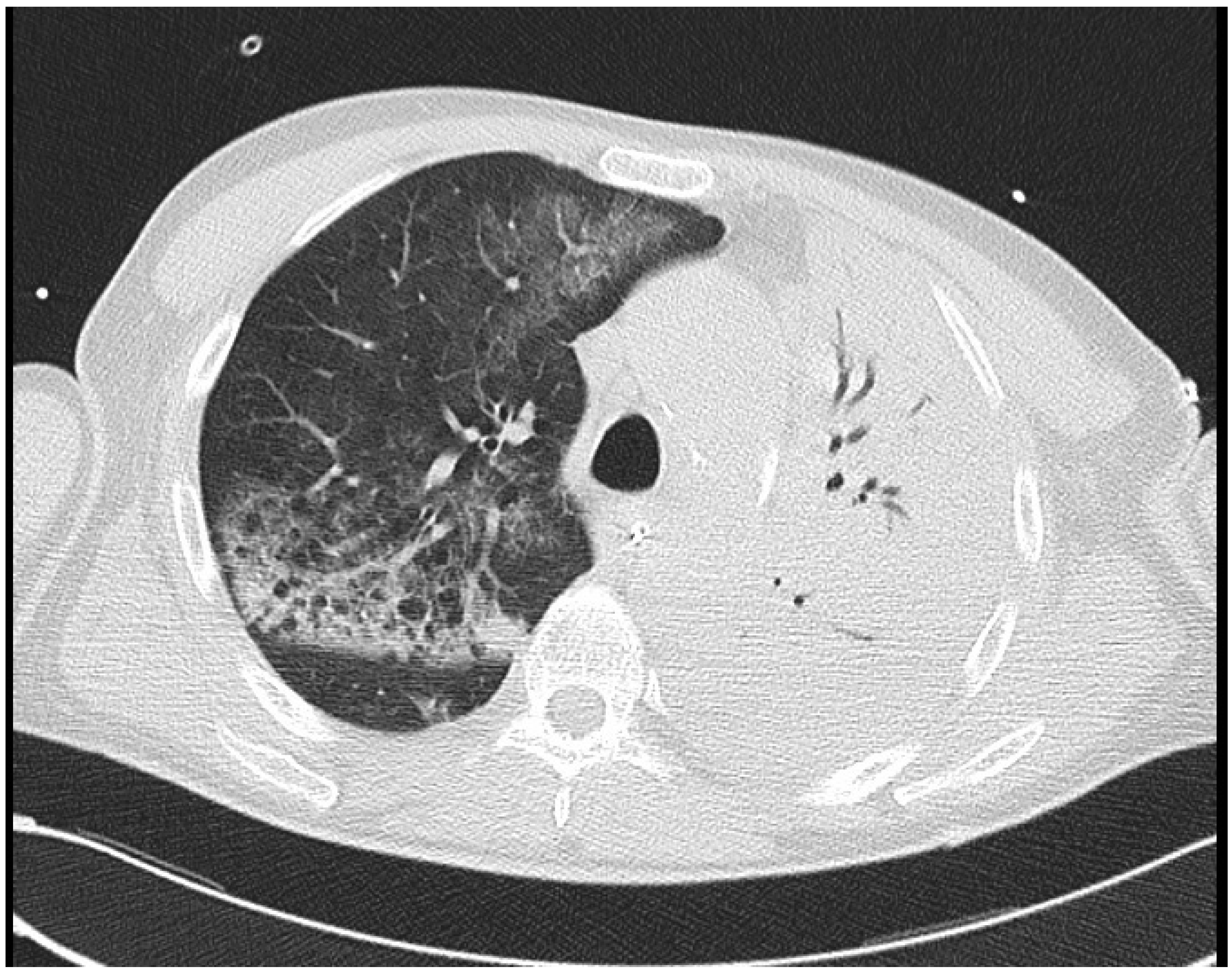 Electrical Impedance Tomography (EIT) to Optimize Ventilatory ...