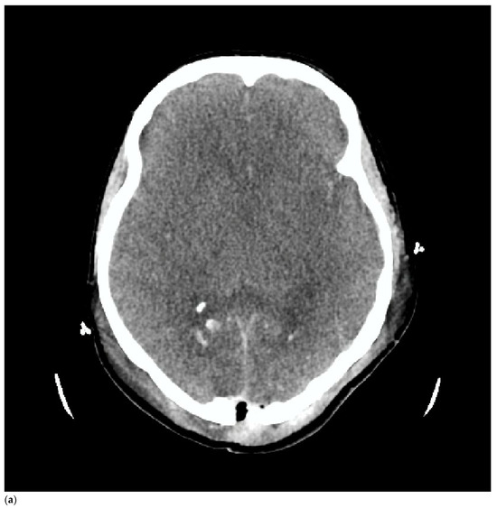 Near-Infrared Spectroscopy (NIRS) in the Assessment of Cerebral Tissue ...