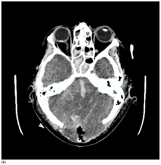 Near-Infrared Spectroscopy (NIRS) in the Assessment of Cerebral Tissue ...