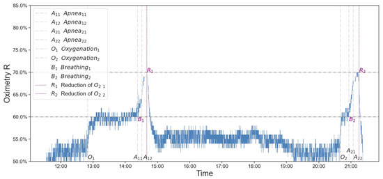 Near-Infrared Spectroscopy (NIRS) in the Assessment of Cerebral Tissue ...