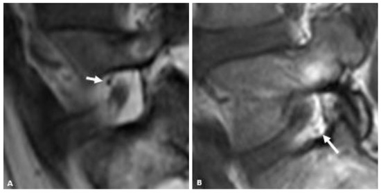 Anesthesia Research | Free Full-Text | The Composition of the L5-S1 Neural Foramen on MRI—A ...