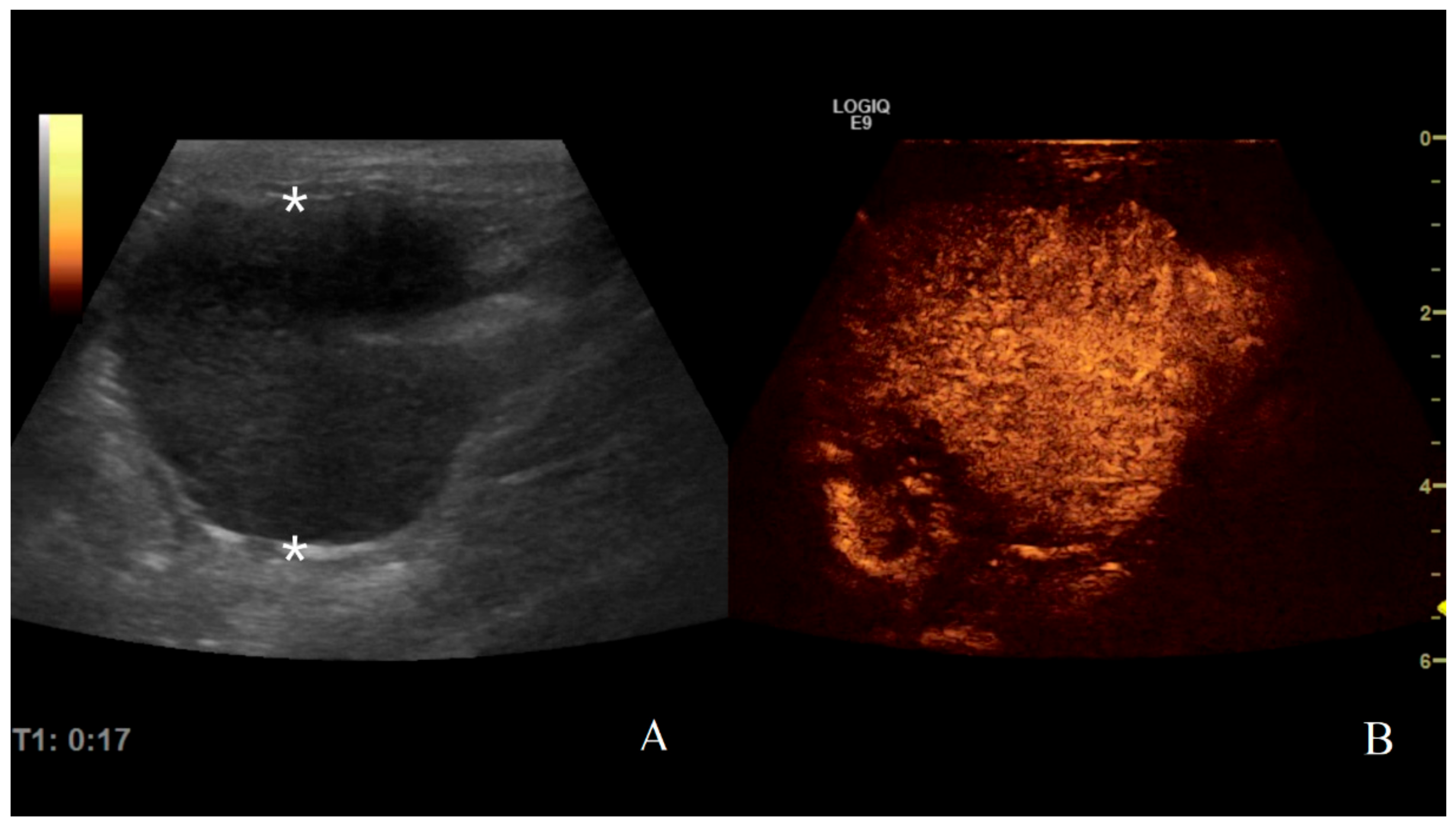 B-Mode and Contrast Enhanced Ultrasonography Features of Gastric ...