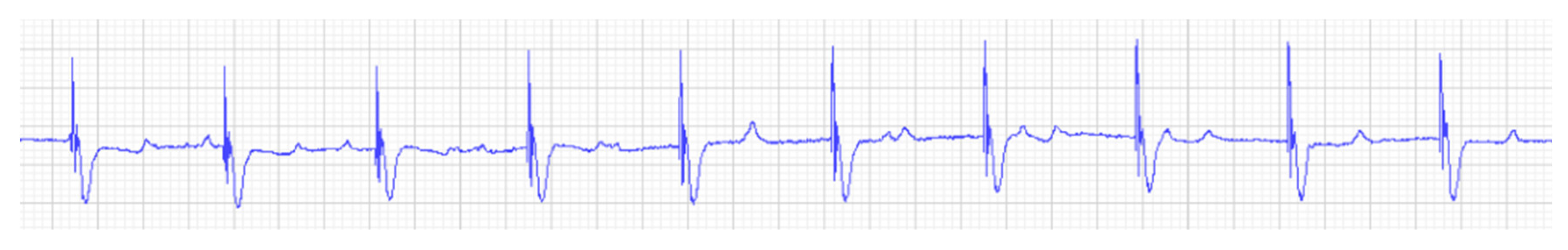 Single-Chamber Cardiac Pacemaker Implantation in a Donkey with Complete ...