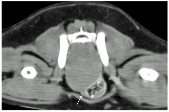 Benign or Low-Grade Malignant Masses Occupying the Pelvic Canal Space ...