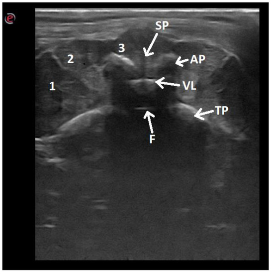 Ultrasonographic Imaging Protocol and Sonoanatomy of the Lumbar Spine ...