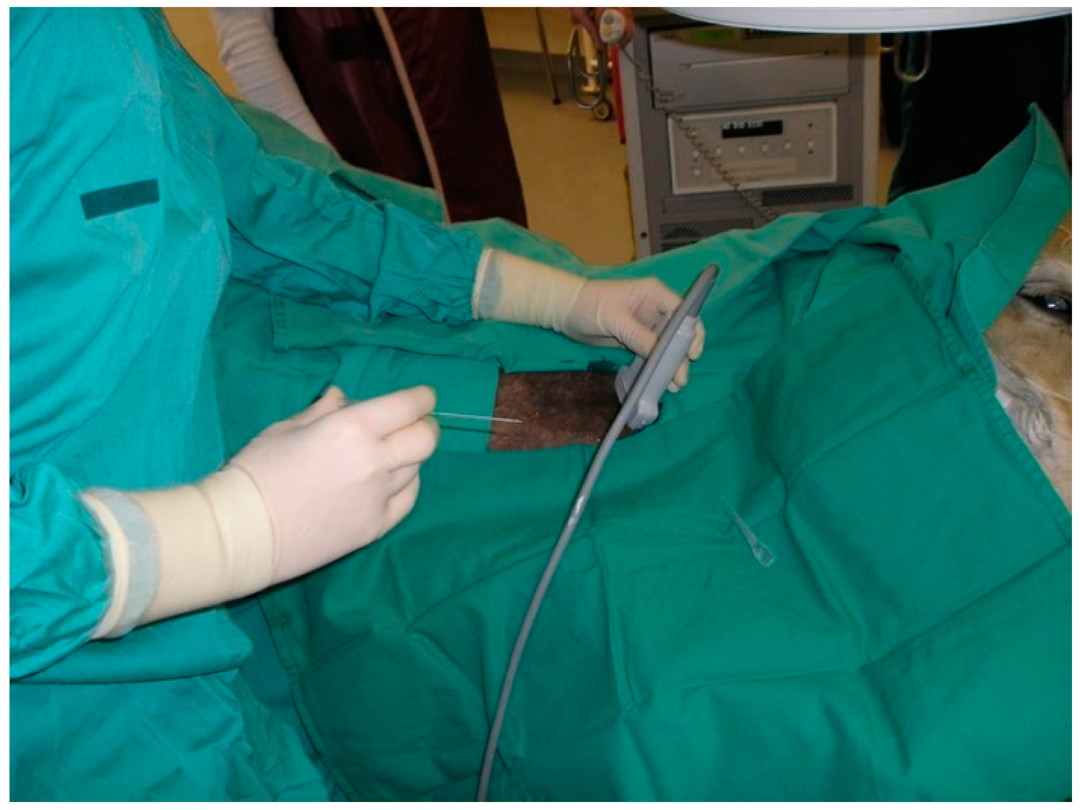Percutaneous Ultrasound-Guided Carotid Access and Puncture Closure with ...
