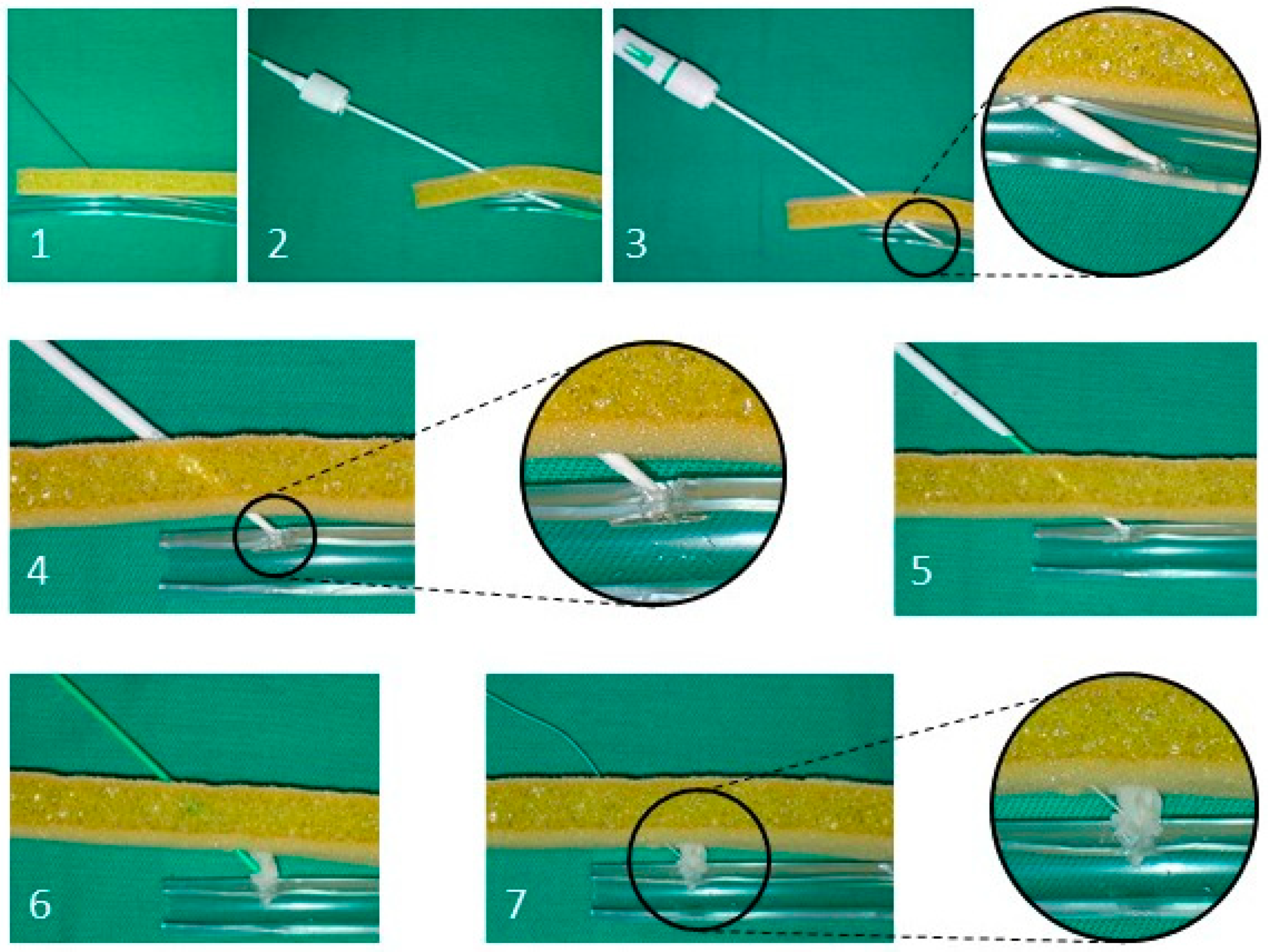 Percutaneous Ultrasound-Guided Carotid Access and Puncture Closure with ...