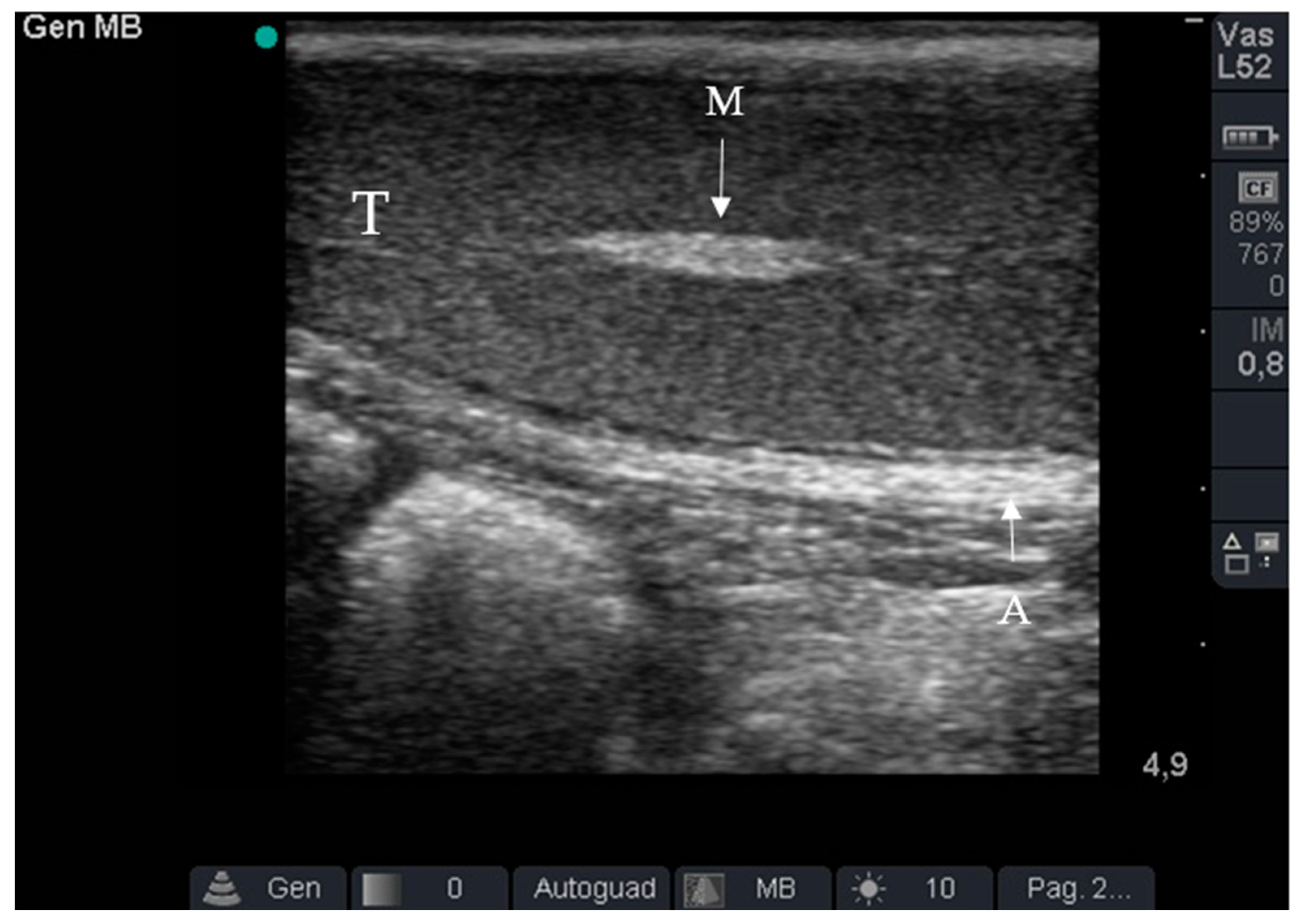 Mediastinum Testis Ultrasound