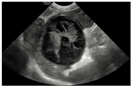 Long-Term Outcome after Cholecystectomy without Common Bile Duct ...