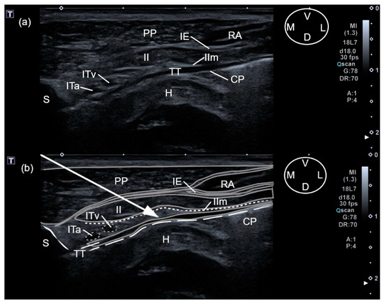 A Two-Point Ultrasound-Guided Injection Technique for the Transversus ...