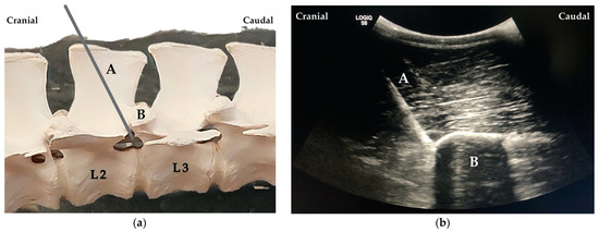 Description of an Ultrasound-Guided Erector Spinae Plane Block and ...