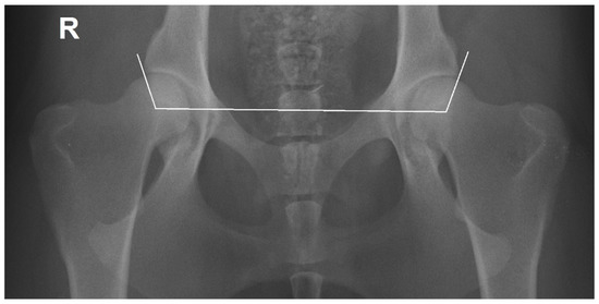 Acetabular Coverage Area Occupied by the Femoral Head as an Indicator ...