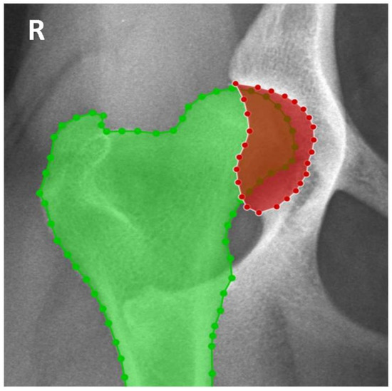 Acetabular Coverage Area Occupied by the Femoral Head as an Indicator ...