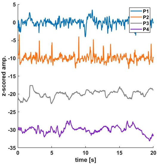 Perioperative Brain Function Monitoring with Electroencephalography in ...