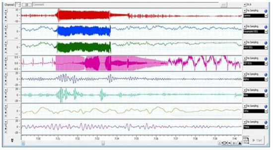 Application of Electroencephalography in Preslaughter Management: A Review