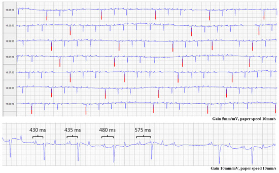 Cartilaginous Intrusion of the Atrioventricular Node in a Quarter Horse ...