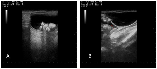 Nontraumatic Paraureteral Urinoma in a Cat with Urolithiasis