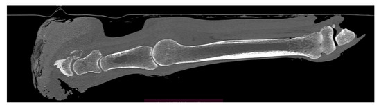 From Keratoma to Anaplastic Malignant Melanoma in a Horse’s Hoof