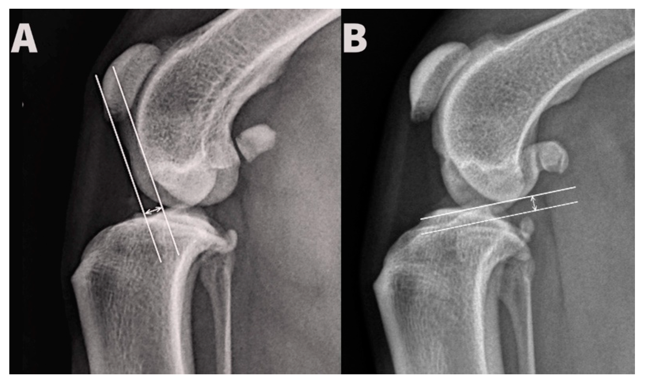 The Effect of Femur Positioning on Measurement of Tibial Plateau Angle ...