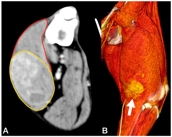 Surgical Excision of Intramuscular Sarcomas: Description of Three Cases ...