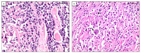 Preliminary Assessment of Tumor-Associated Tissue Eosinophilia (TATE ...