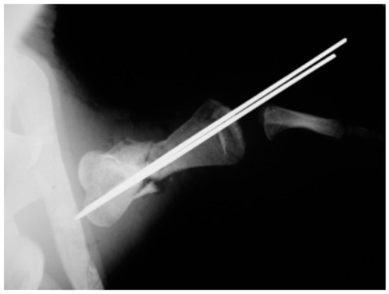 Bone Healing Process of a Multiple Humeral Fracture in a Caretta ...