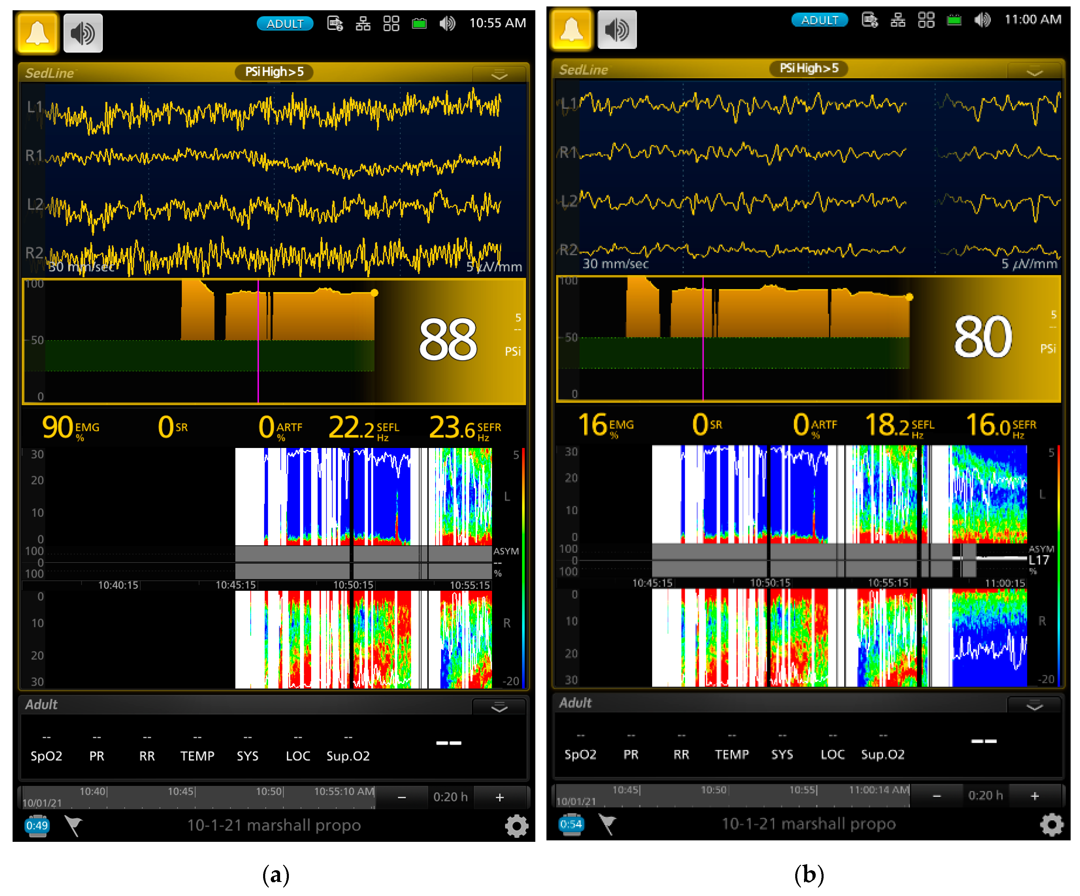 Electroencephalographic and Cardiovascular Changes Associated with ...