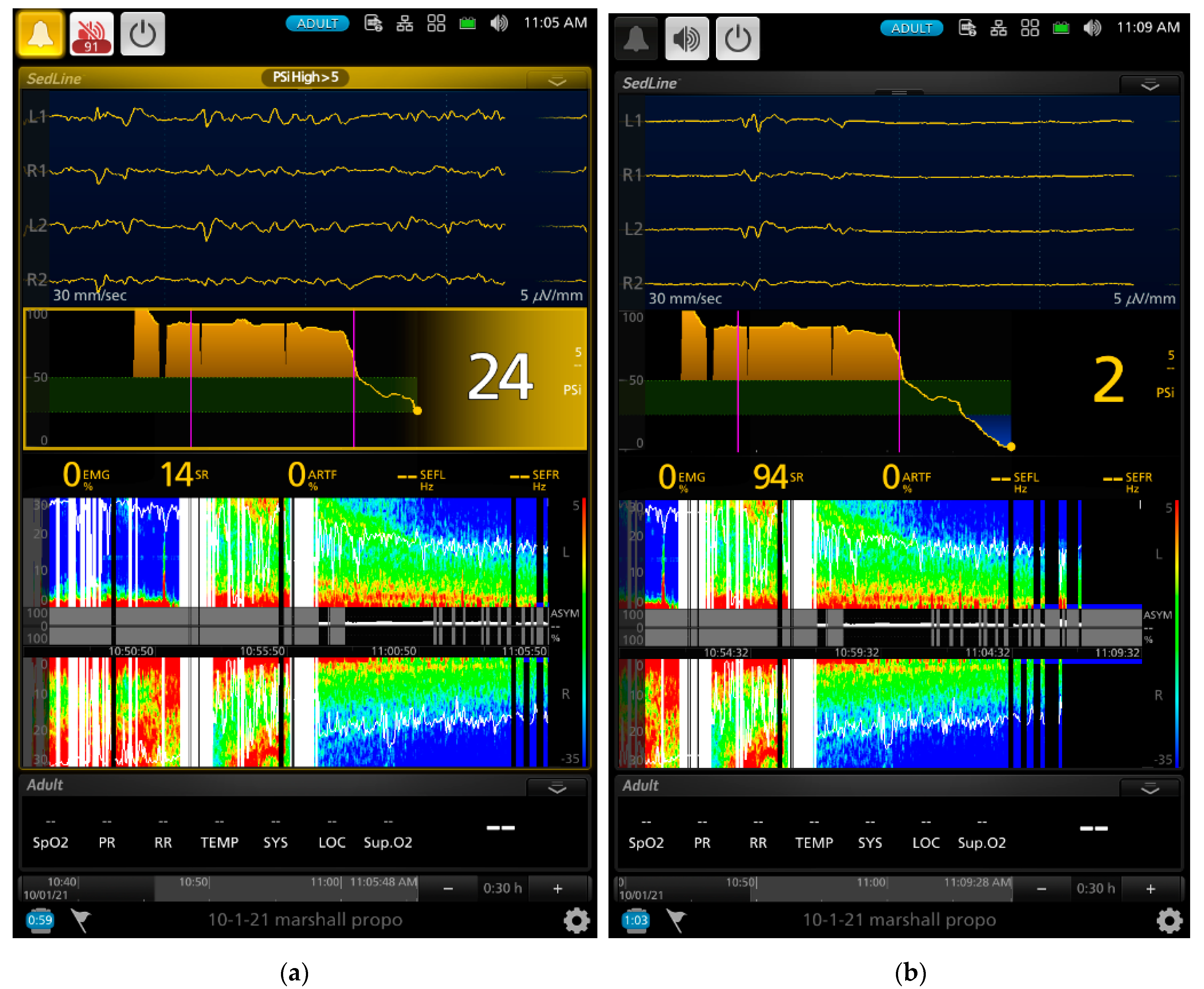 Electroencephalographic and Cardiovascular Changes Associated with ...