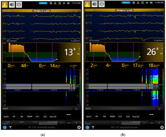 Electroencephalographic and Cardiovascular Changes Associated with ...