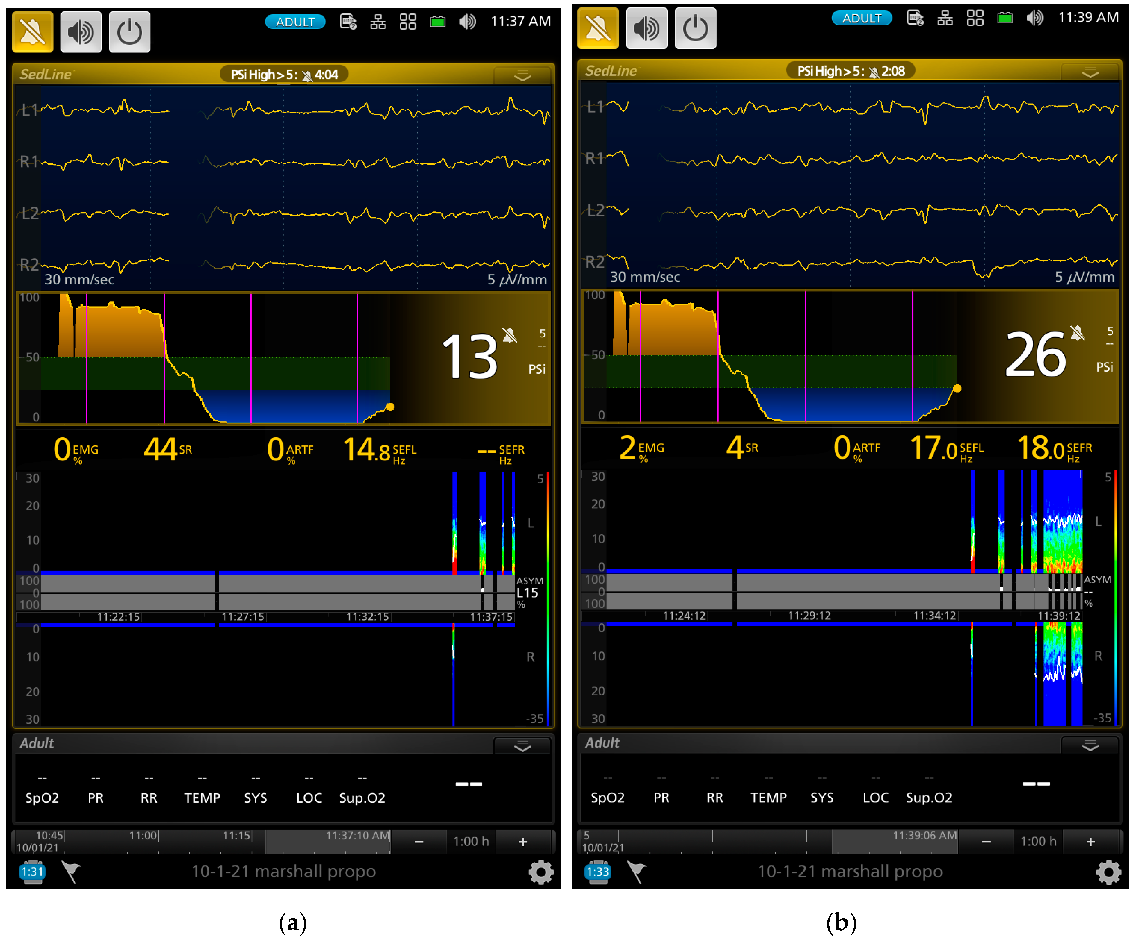 Electroencephalographic and Cardiovascular Changes Associated with ...