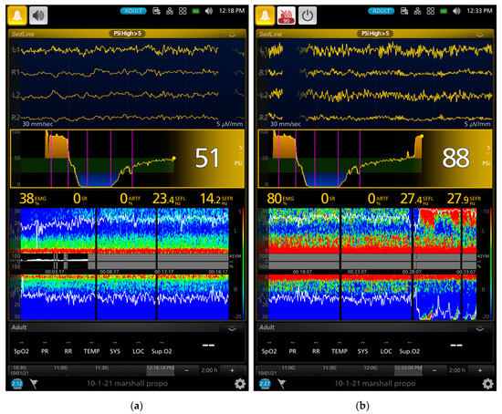 Electroencephalographic and Cardiovascular Changes Associated with ...