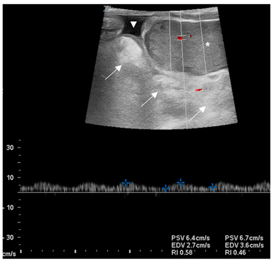 Laparoscopically Assisted Percutaneous Inguinal Ring Closure for ...