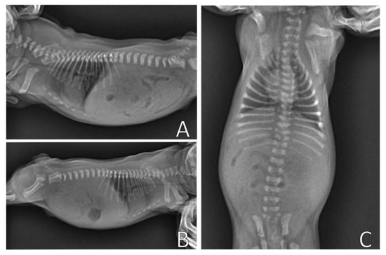 Two Types of Management for the Noninvasive Treatment of Pectus ...