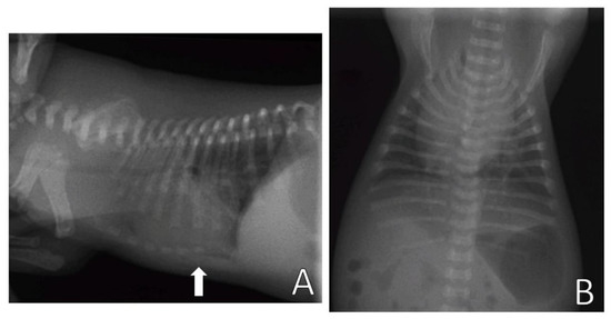 Two Types of Management for the Noninvasive Treatment of Pectus ...