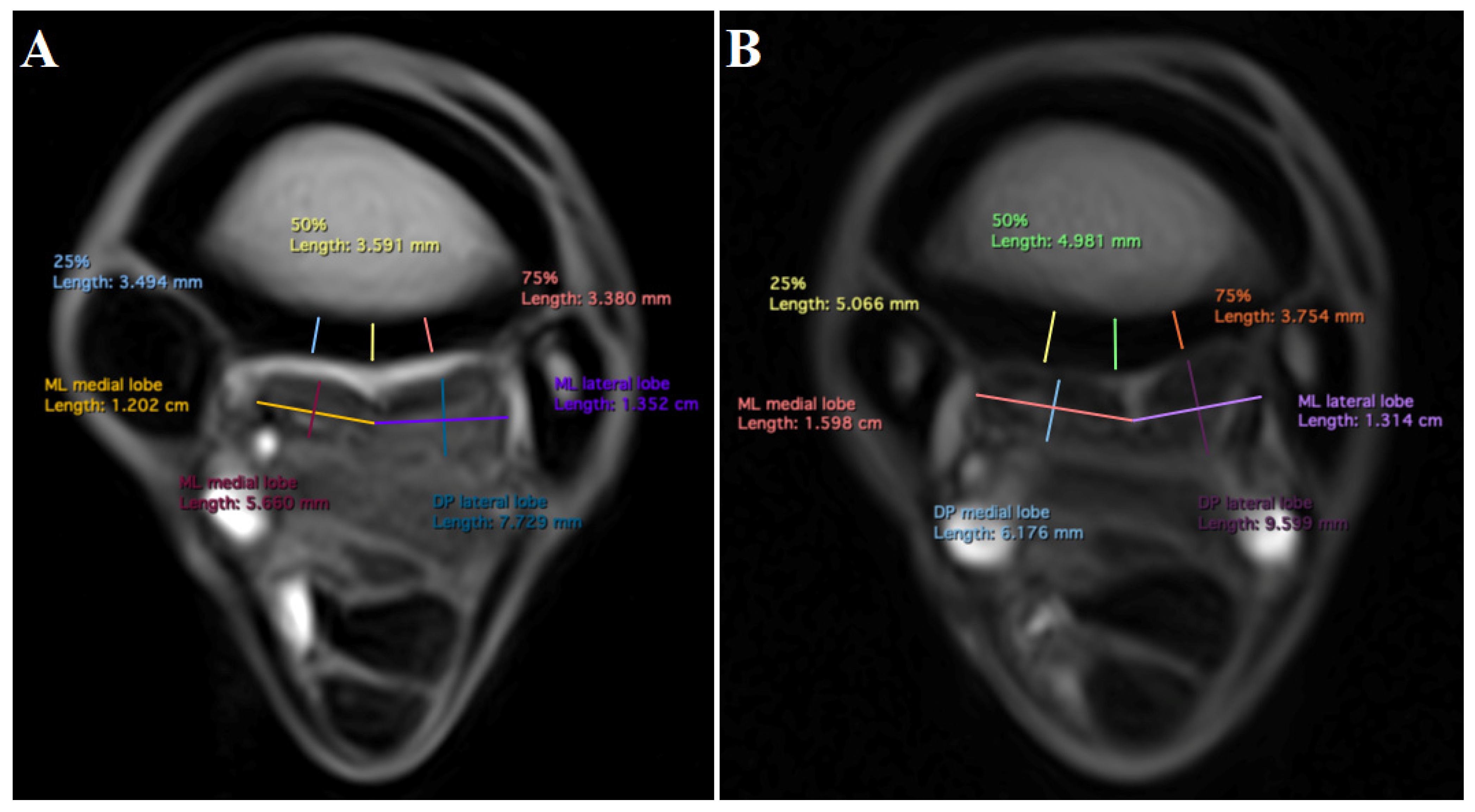 Magnetic Resonance Imaging Measurements of the Proximal Palmar Cortex ...