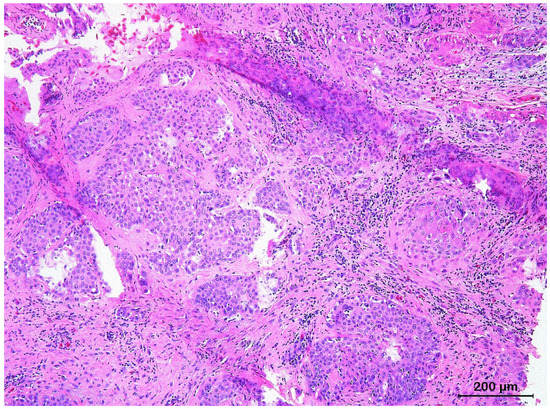 Histological Variants of Squamous and Basal Cell Carcinoma in Squamates ...
