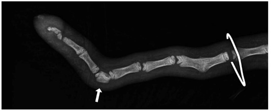 Frequency and Characterisation of Anomalies and Fractures of the Caudal ...